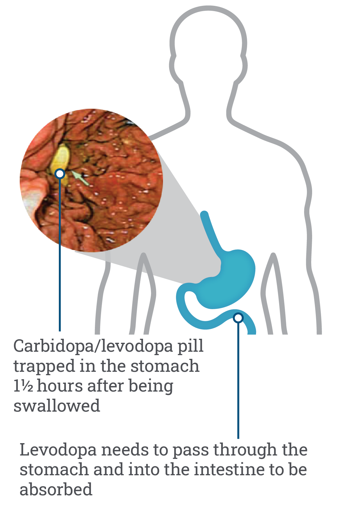 How Parkinson s Disease Advances DUOPA carbidopa levodopa How Parkinson s Disease Advances DUOPA carbidopa levodopa
